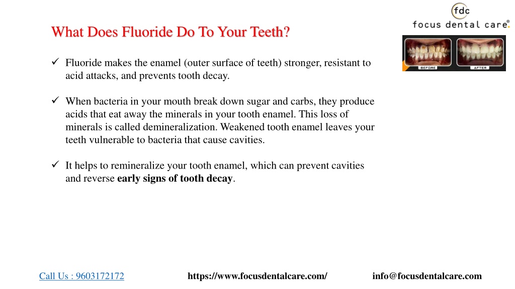 PPT - How Fluoride Helps in Cavity Prevention | Focus Dental PowerPoint ...