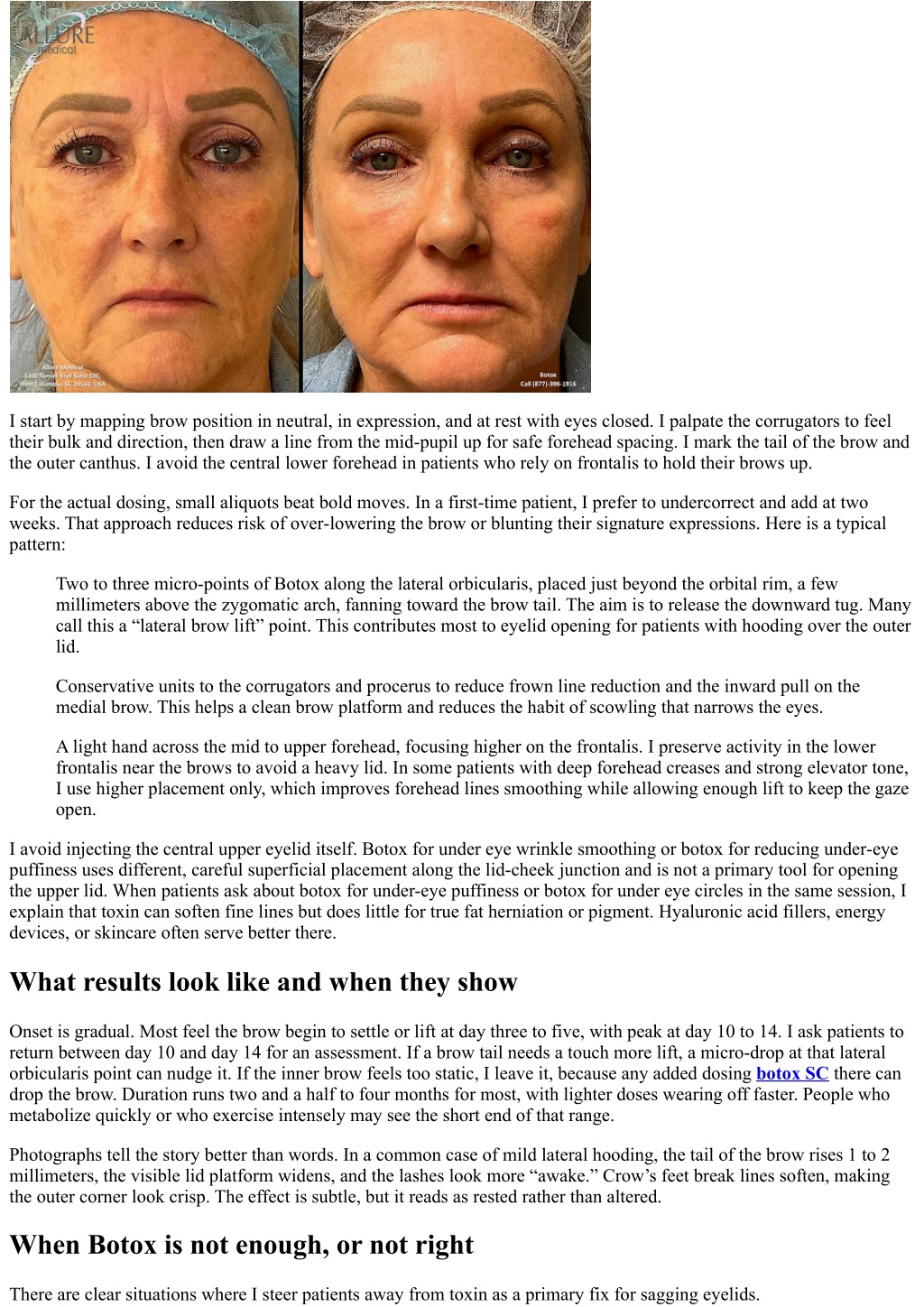 PPT - Awaken the Eyes: Botox for Sagging Eyelids PowerPoint ...