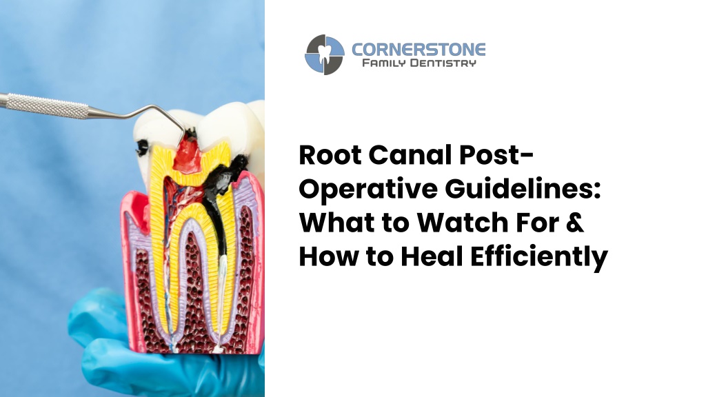 PPT - Root Canal Post-Operative Guidelines: What to Watch For & How to ...